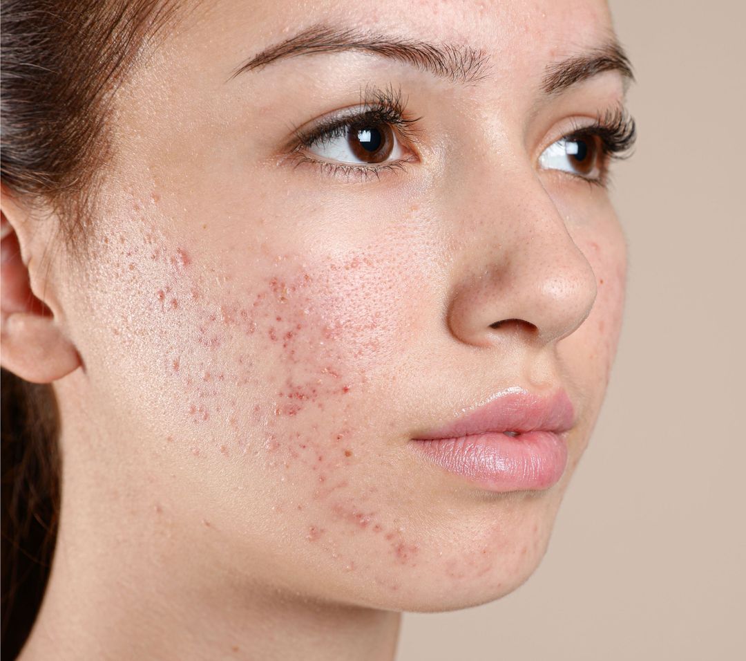 Laser Acne Treatment Meraki A Full Service Boutique Medical Spa In